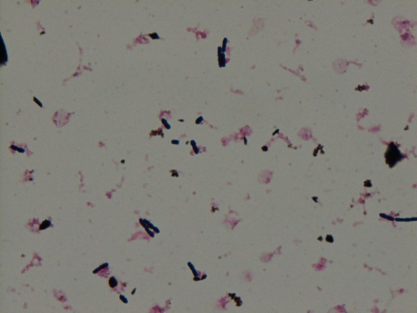Microbiology Case Study: 58 Year Old Male with Right Upper Quadrant ...