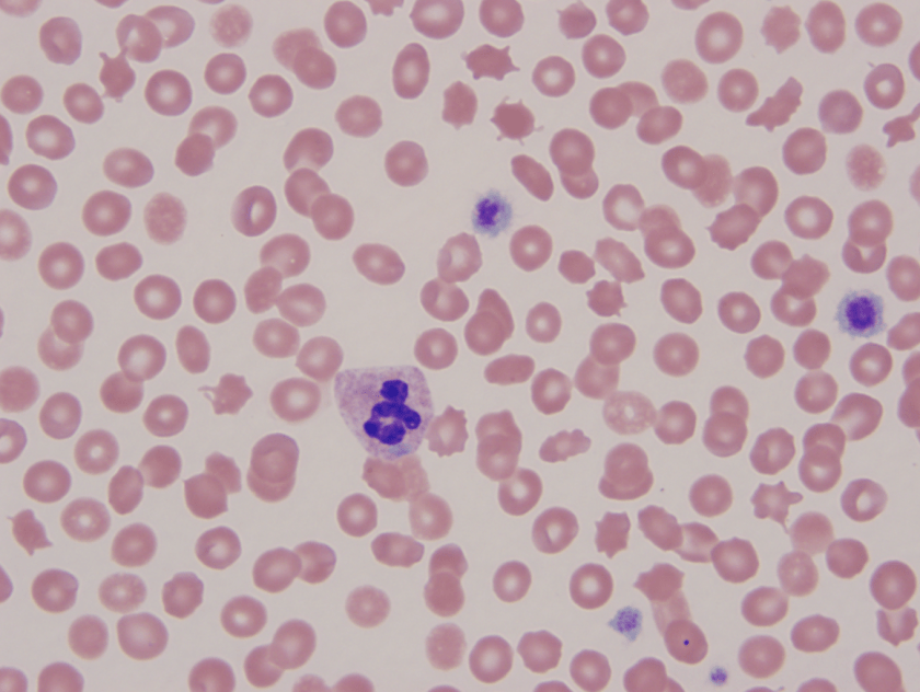 Peripheral Smear Review: Inexpensive Test to Establish Diagnosis of a ...
