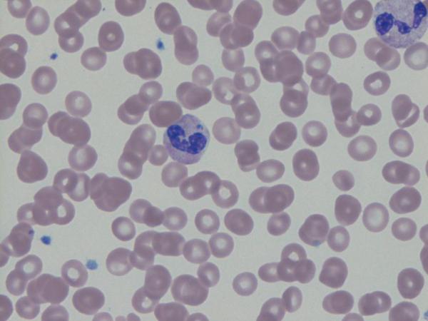 tick-borne disease – Lablogatory
