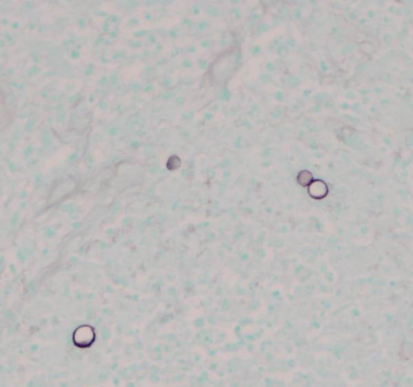 Blastomyces – Lablogatory