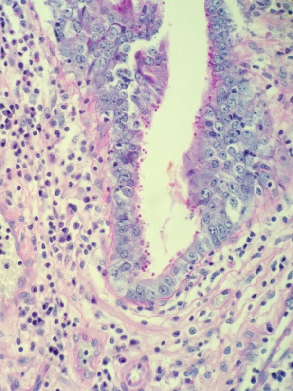 Microbiology Case Study: A 43 Year Old Man with AIDS – Lablogatory