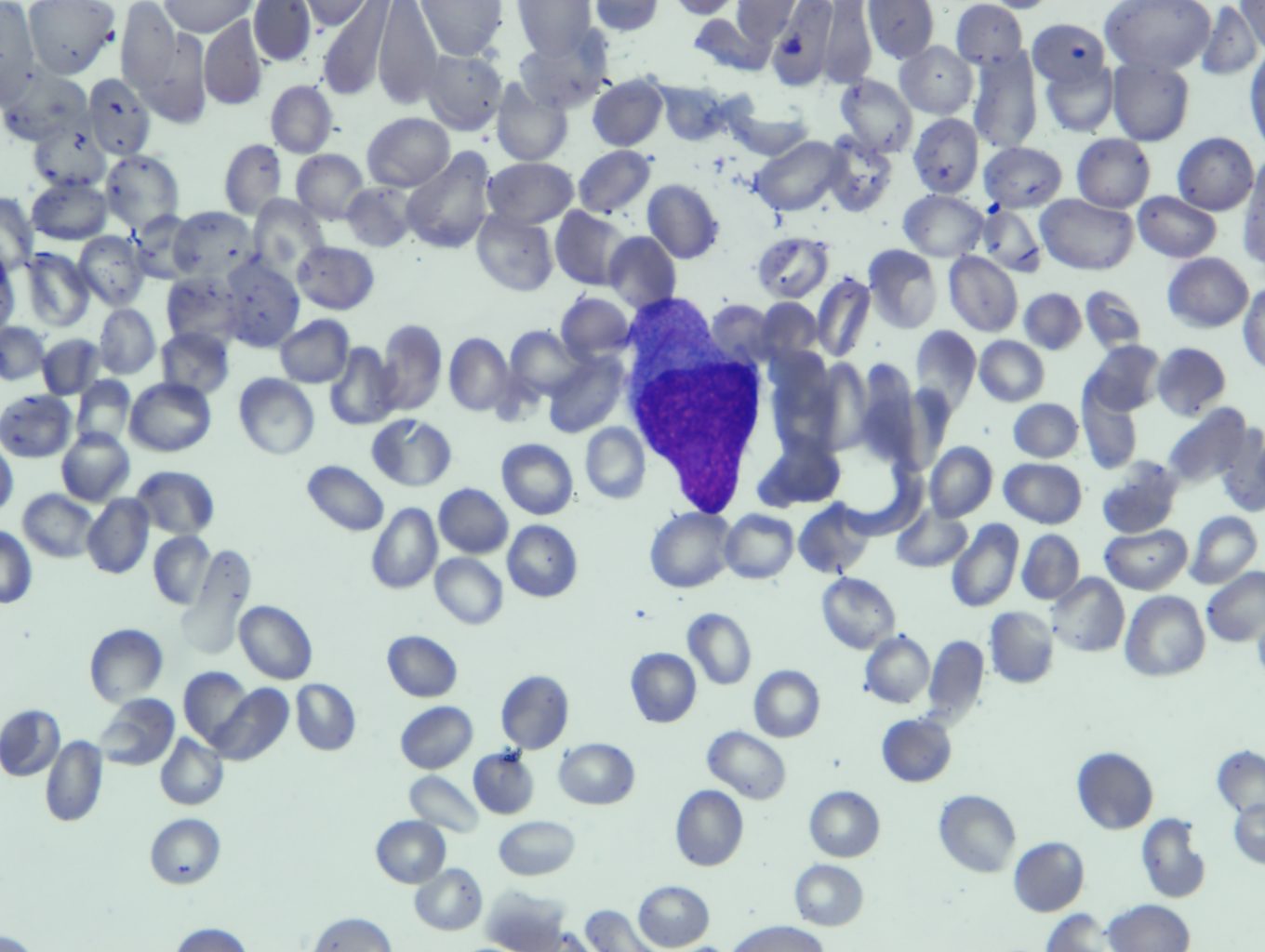 Blast Morphology Predicting Presence of a Specific Translocation ...