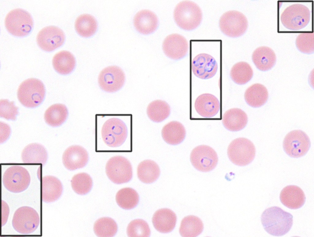 Microbiology Case Study: A 26 Year Old Female with Peri-partum Fever ...
