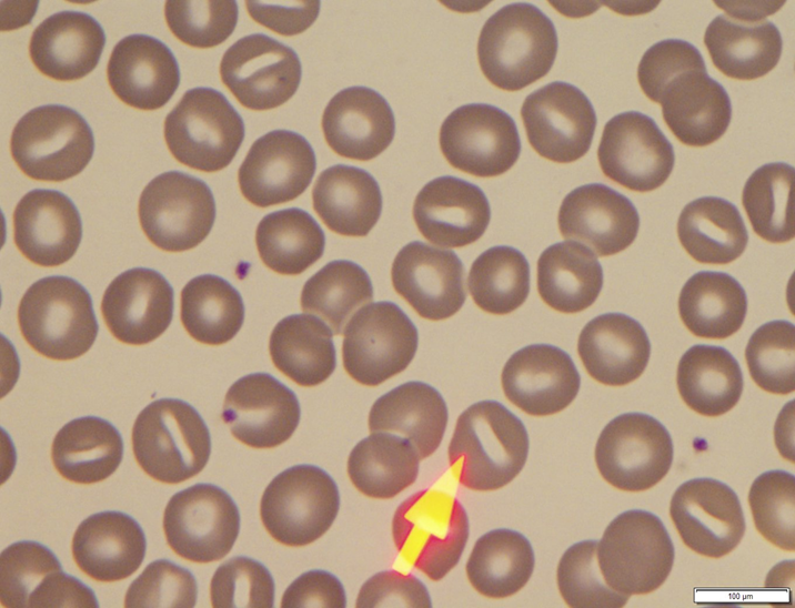 Stomatocytes: Inherited or Acquired? – Lablogatory