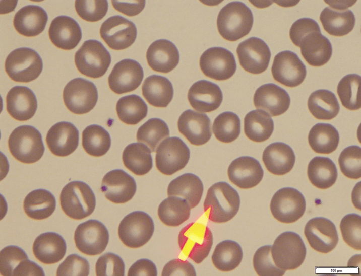 Stomatocytes: Inherited or Acquired? – Lablogatory