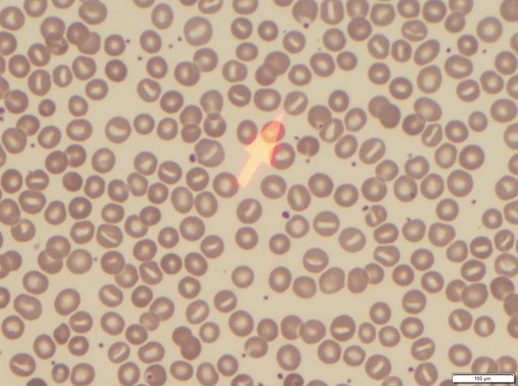 RBC morphology – Lablogatory