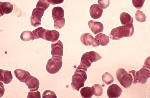 Hematology Quiz: A Patient with Multiple Myeloma – Lablogatory