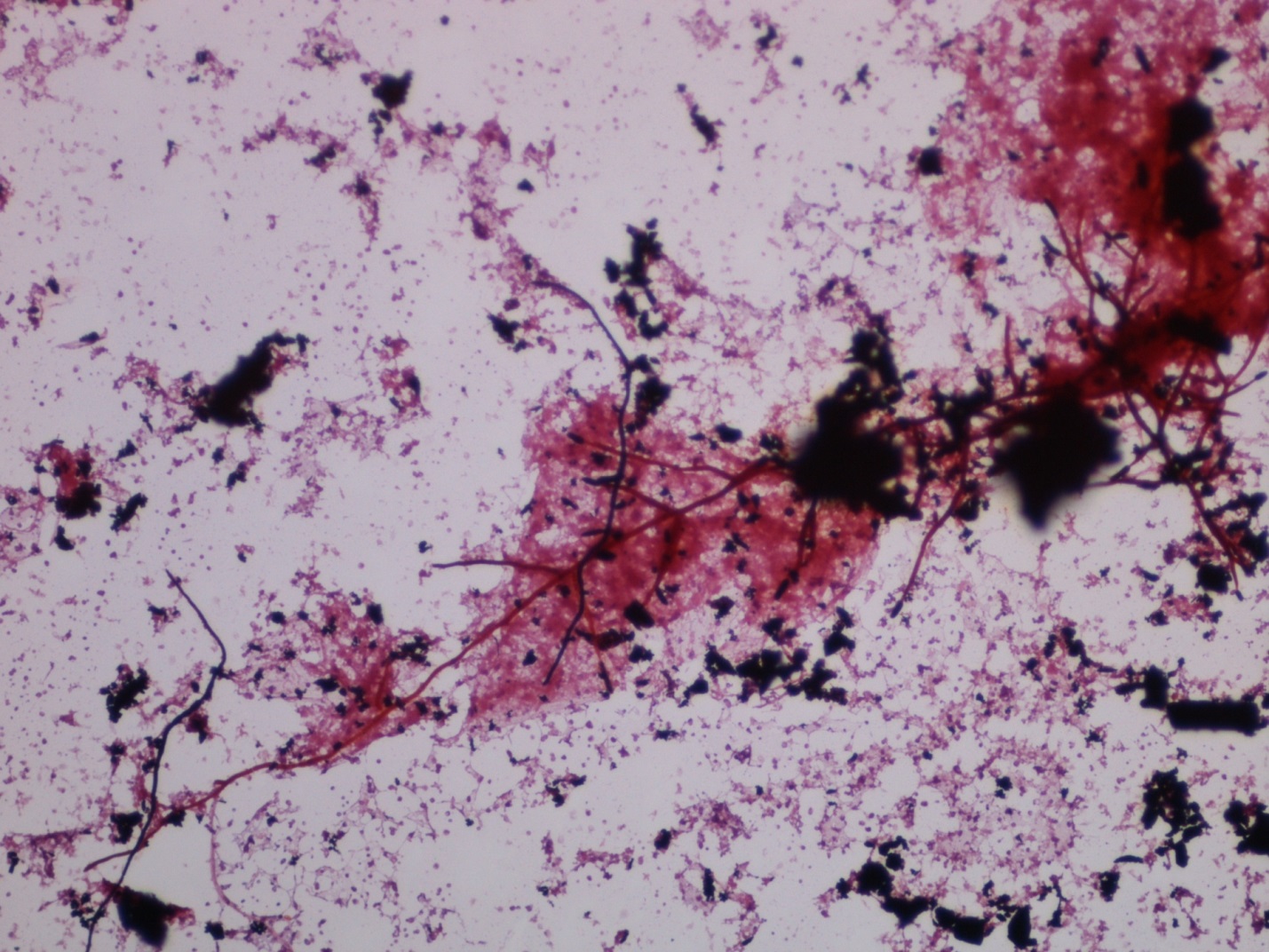 Microbiology Case Study: A 57 Year Old Woman with Recurrent Fever ...