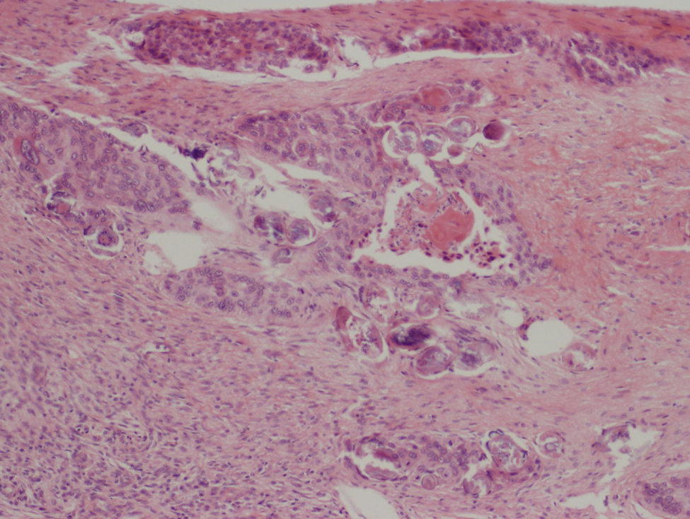 Microbiology Case Study: A 50 year Old Man with Dysuria and Hematuria ...