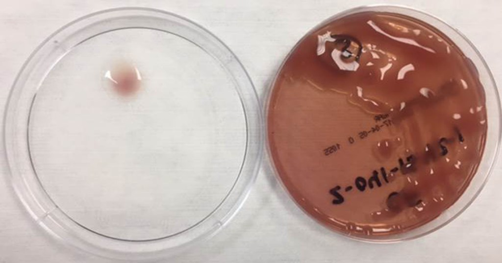 Microbiology Case Study: A 14 Year Old Cystic Fibrosis Patient ...