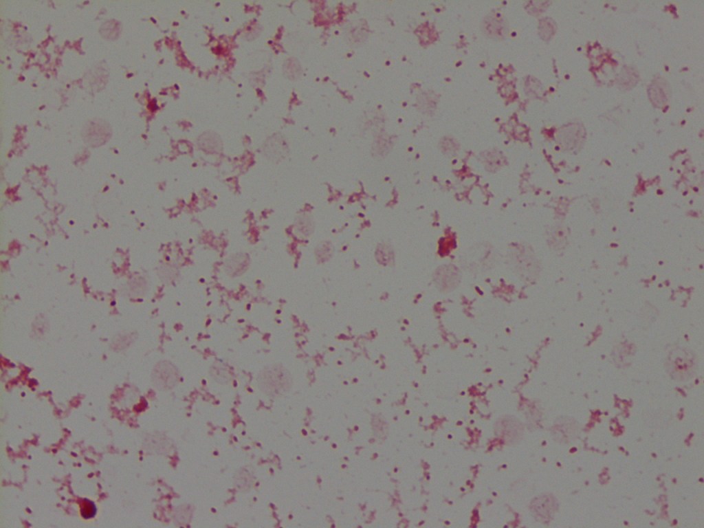 Microbiology Case Study: A 64 Year Old with Coronary Artery Disease ...