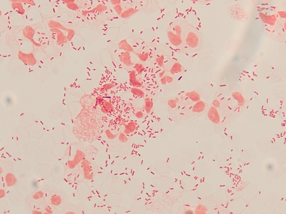 Microbiology Case Study: A 58 Year Old Female with Fever, Headache, and ...