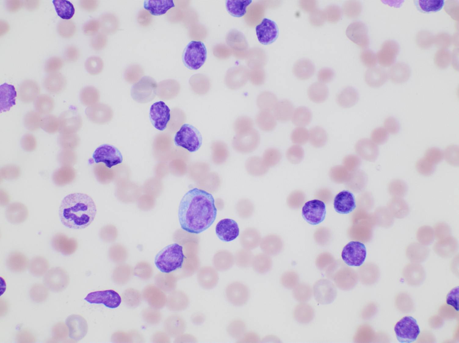 Hematology Case Study: An 80 Year Old Male with History of CLL ...