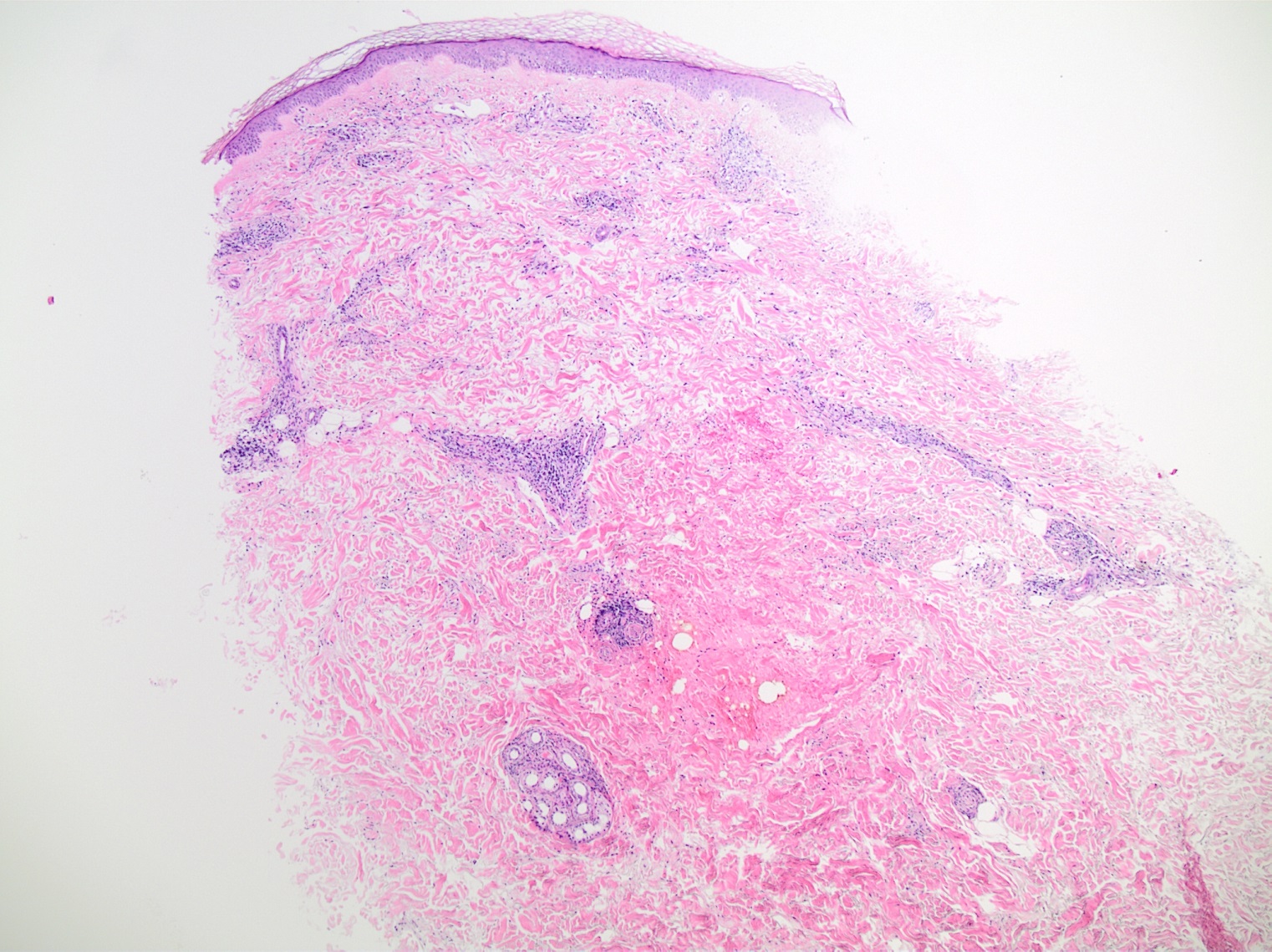 Microbiology Case Study: A 60 Year Old Male with Longstanding Skin Lesions – Lablogatory