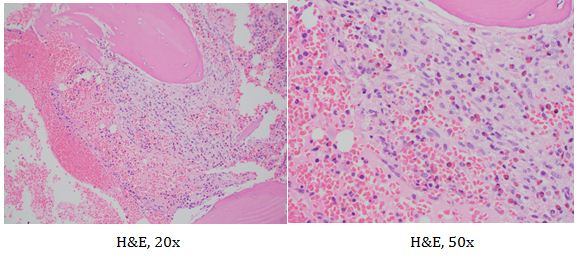 Hematopathology Case Study: A 69 Year Old Female with Persistent ...