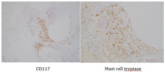 Hematopathology Case Study: A 69 Year Old Female with Persistent ...