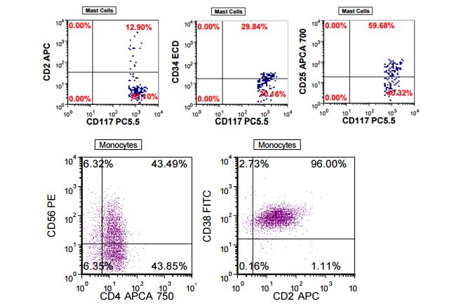 Hematopathology Case Study: A 69 Year Old Female with Persistent ...