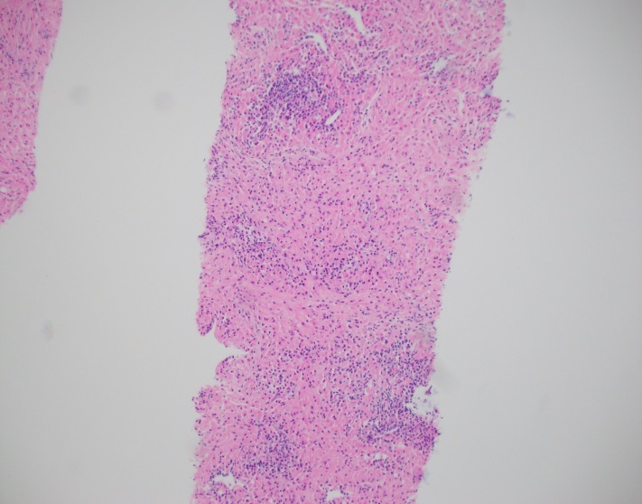 Hematopathology Case Study: What’s in Those Histiocytes? – Lablogatory