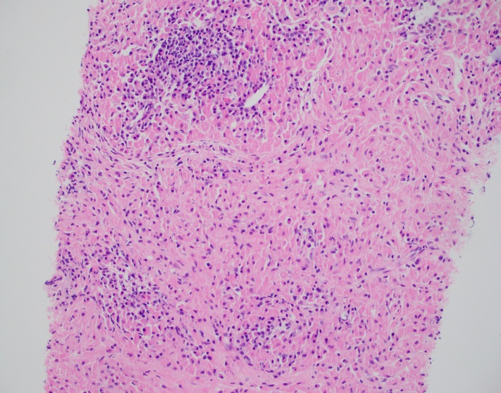 Hematopathology Case Study: What’s in Those Histiocytes? – Lablogatory