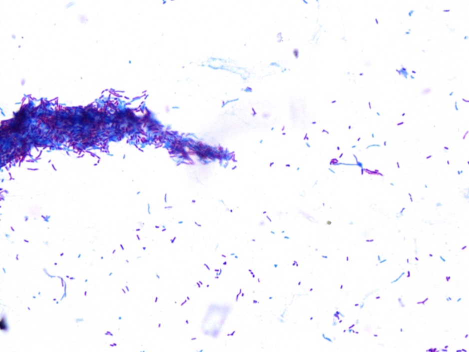 Microbiology Case Study: A 58 Year Old Female with Lung Nodules ...