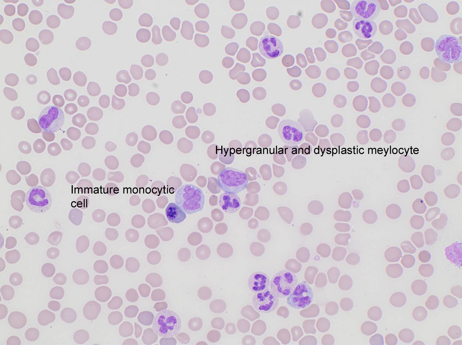 Hematology Case Study: Monocytosis in An Elderly Patient – Lablogatory