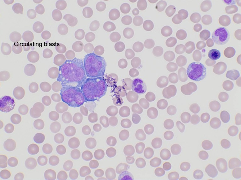 Hematology Case Study: Monocytosis in An Elderly Patient – Lablogatory
