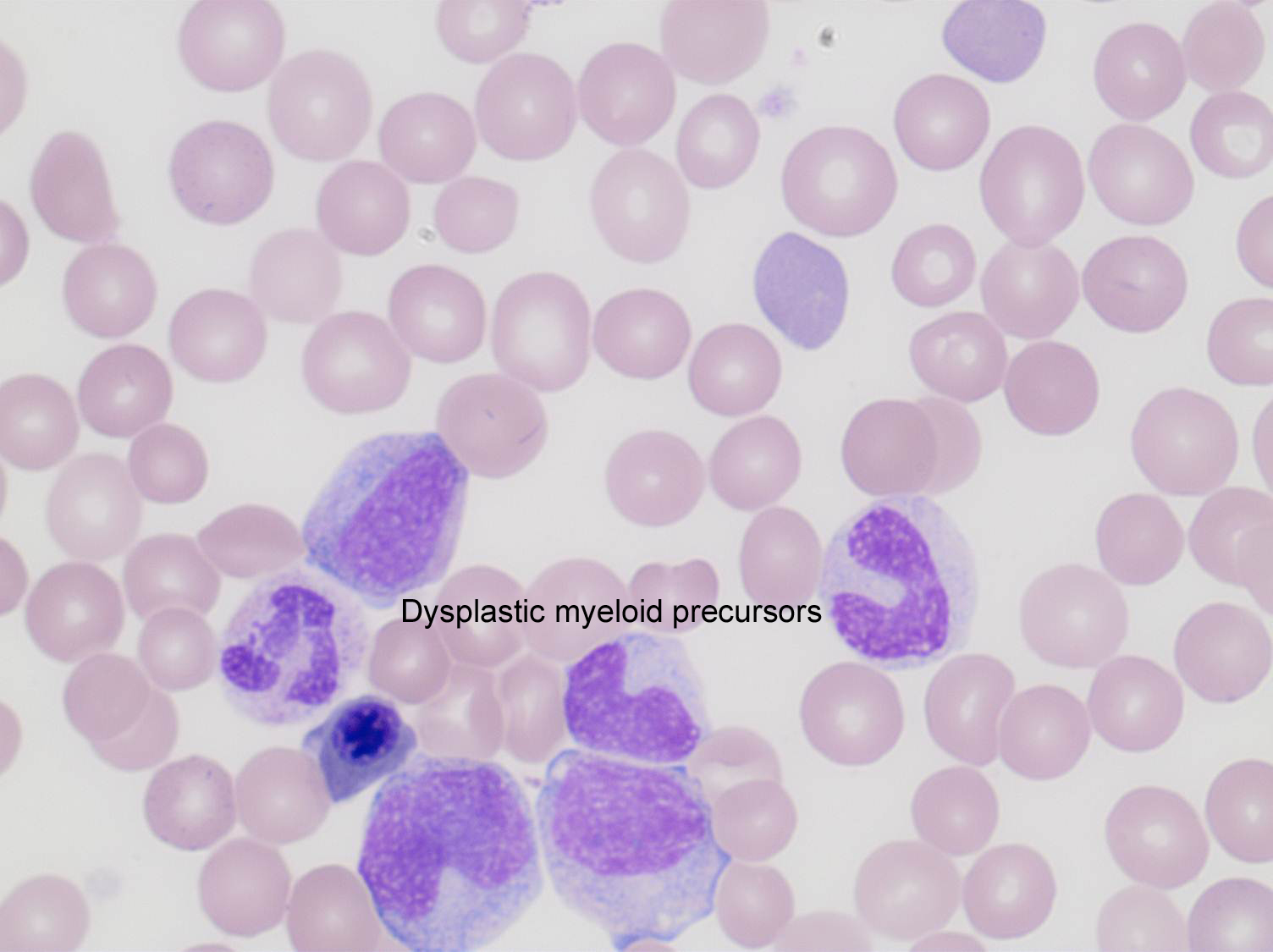 Hematology Case Study: Monocytosis in An Elderly Patient – Lablogatory