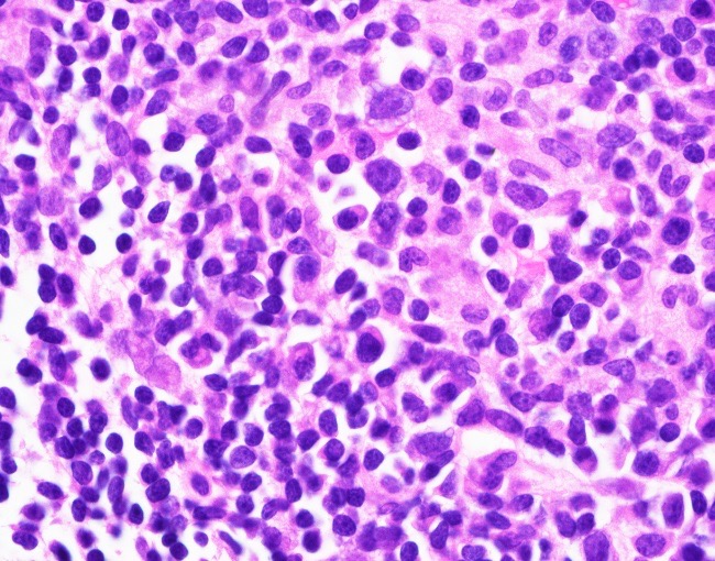 Hematopathology Case Study: A 56 Year Old Male with an Enlarged Lymph ...