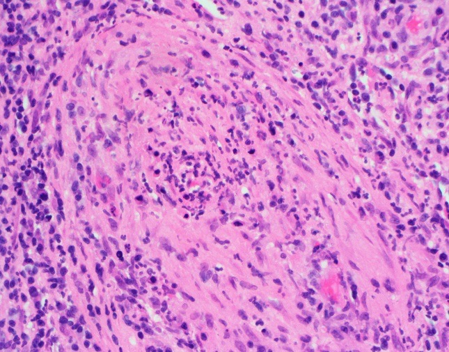 Hematopathology Case Study: A 56 Year Old Male with an Enlarged Lymph ...