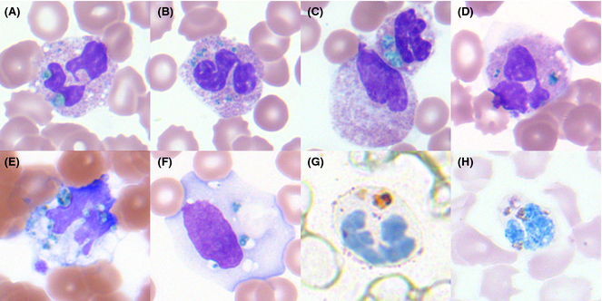 Hematology Case Study: Crystal of Death – Lablogatory