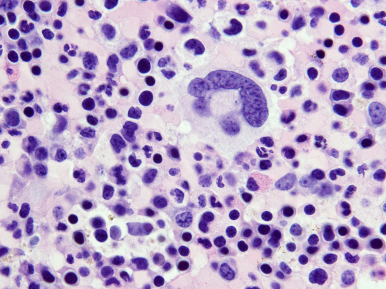 Hematopathology Case Study: A 45 Year Old Man with Cytopenias and High ...