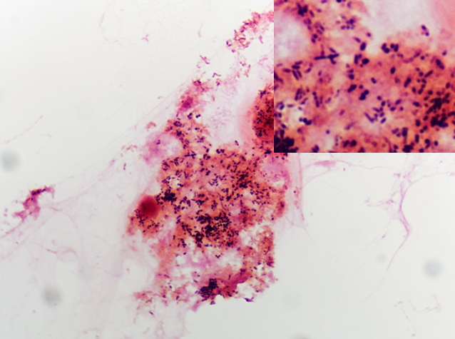 Microbiology Case Study: 6 Year Old Male with Meningitis – Lablogatory