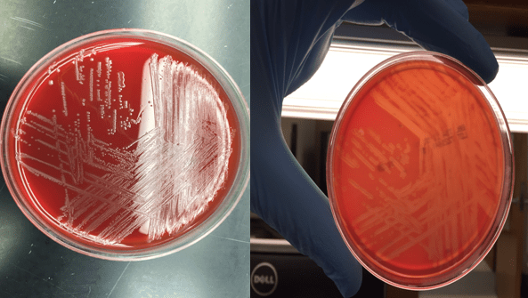 Microbiology Case Study: 6 Year Old Male with Meningitis – Lablogatory