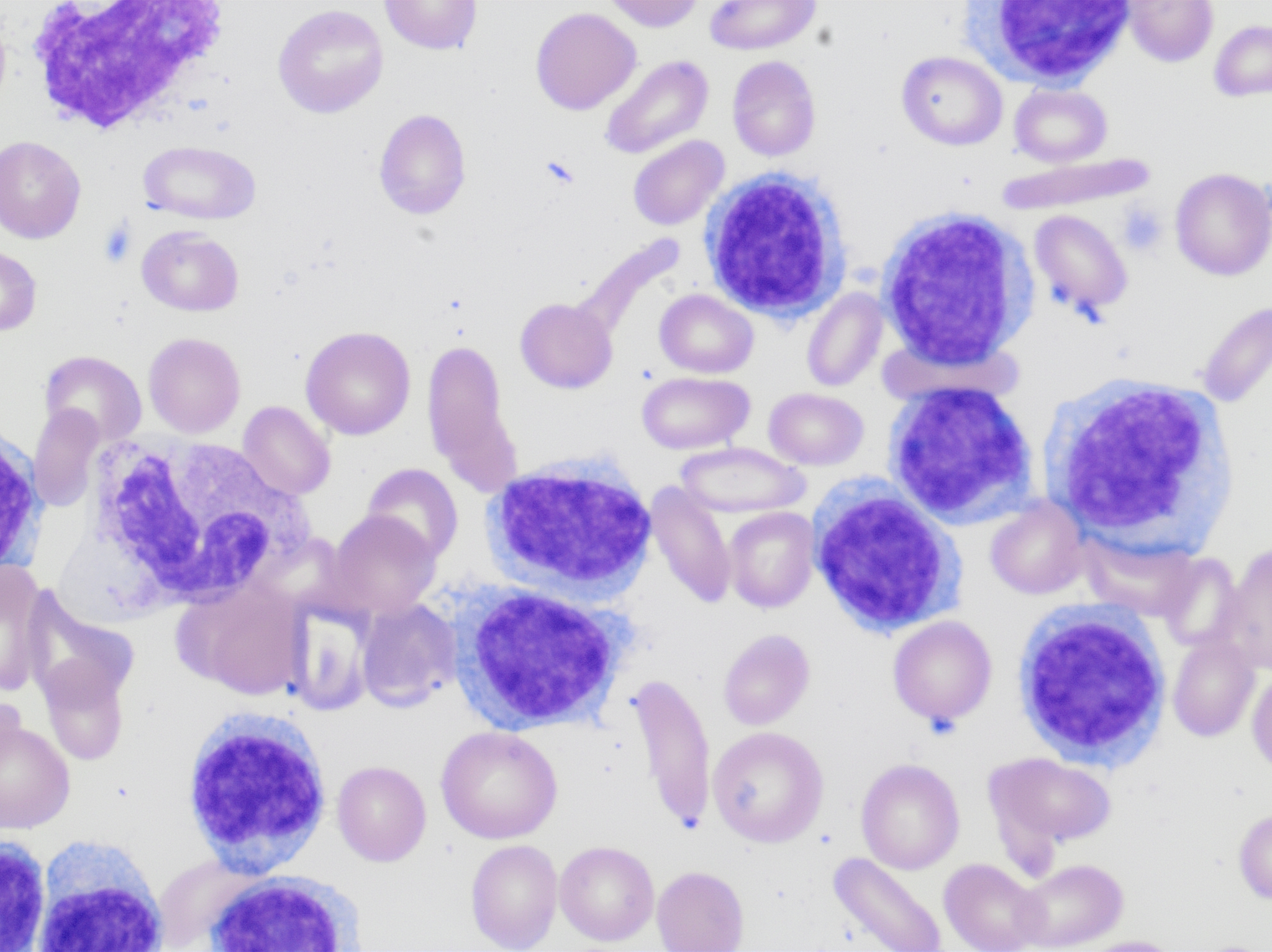 Lymphocytosis Can Be Anything – Lablogatory