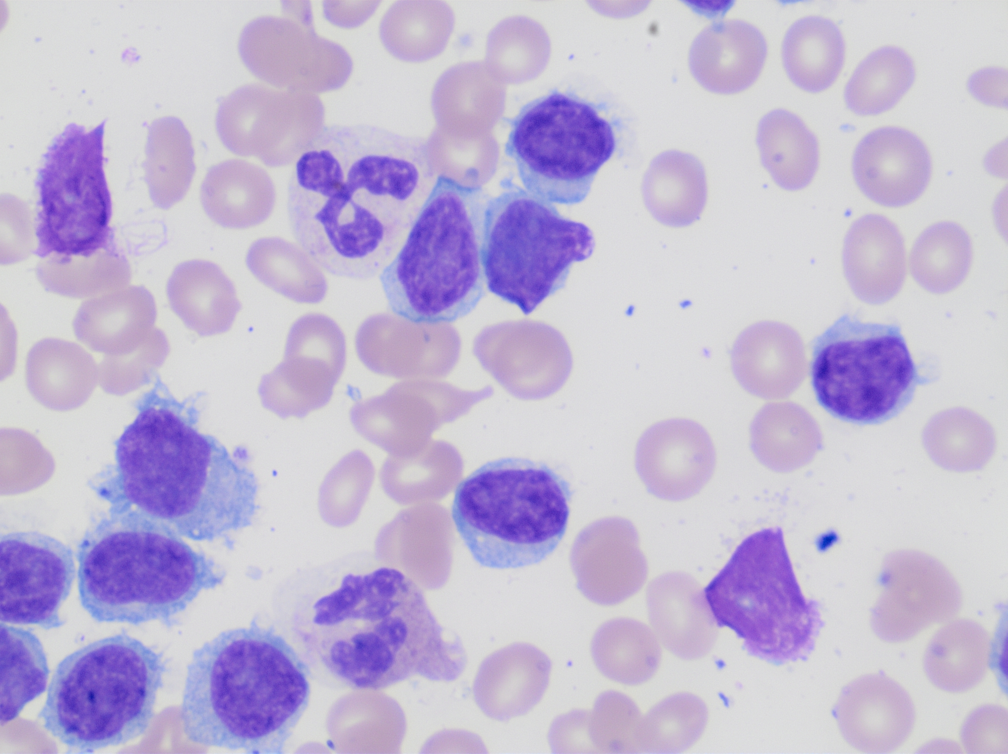 Lymphocytosis Can Be Anything – Lablogatory