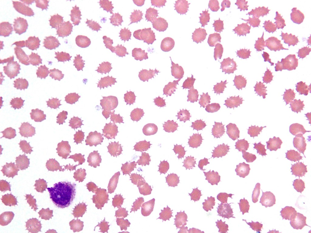 Hematopathology Case Study: An 18-year-old Man with Acanthocytosis ...