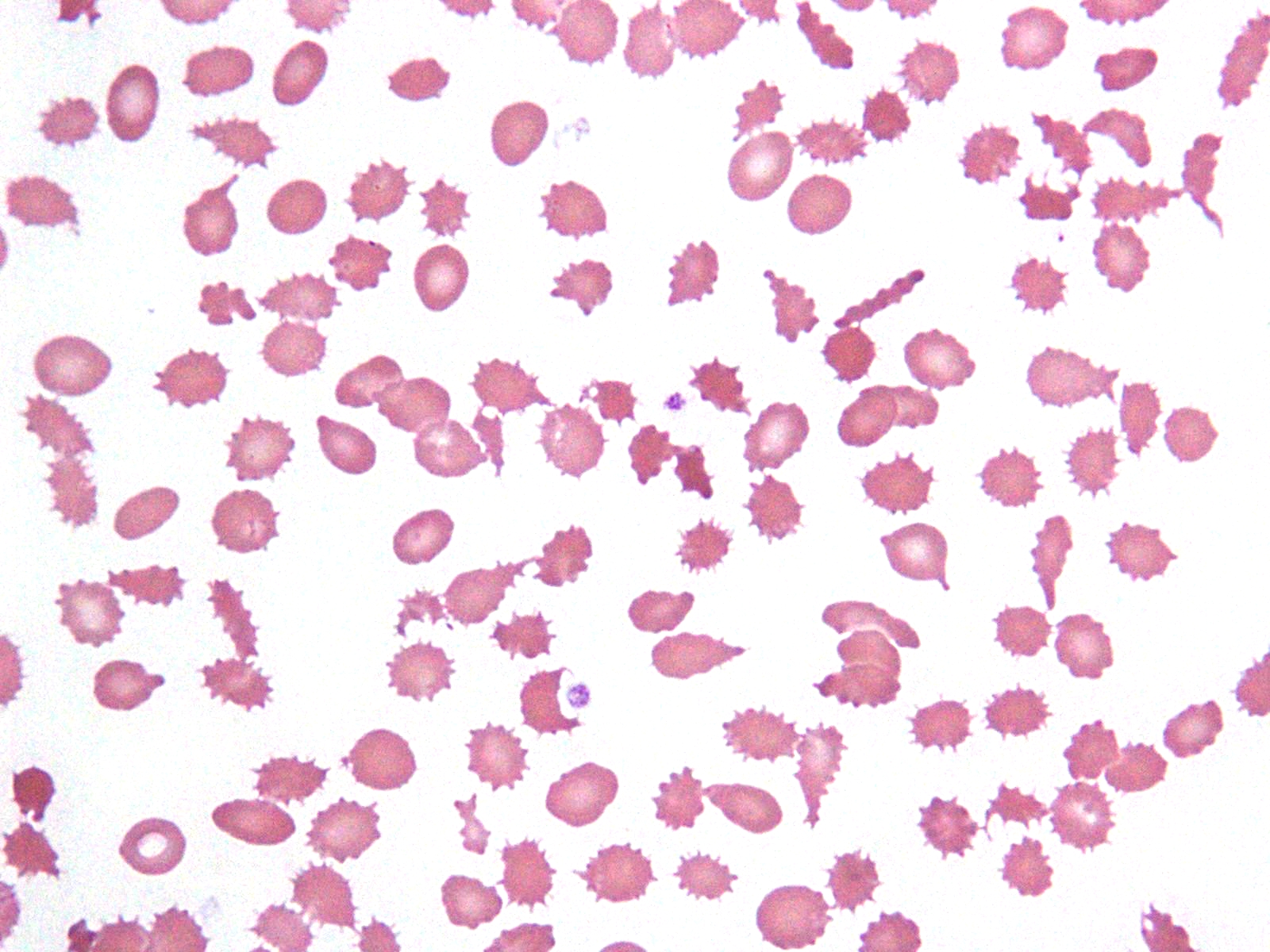 Hematopathology Case Study: An 18-year-old Man with Acanthocytosis ...