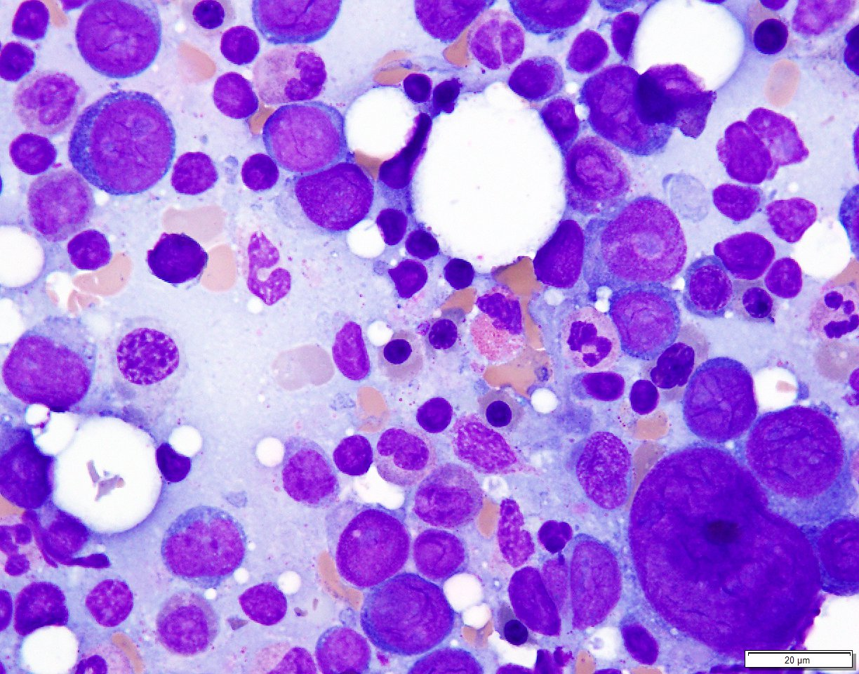 Hematopathology Case Study: A 69-Year-Old Man Presenting with Marked ...