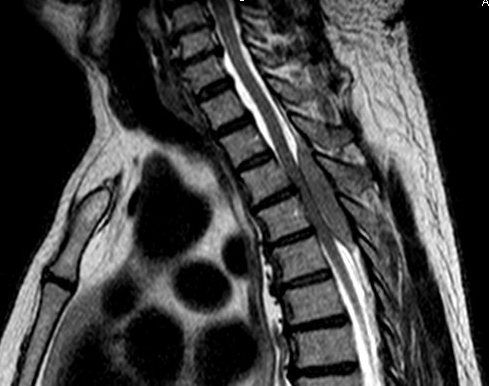 Hematopathology Case Study: A 68 Year Old Man with Epidural Mass ...