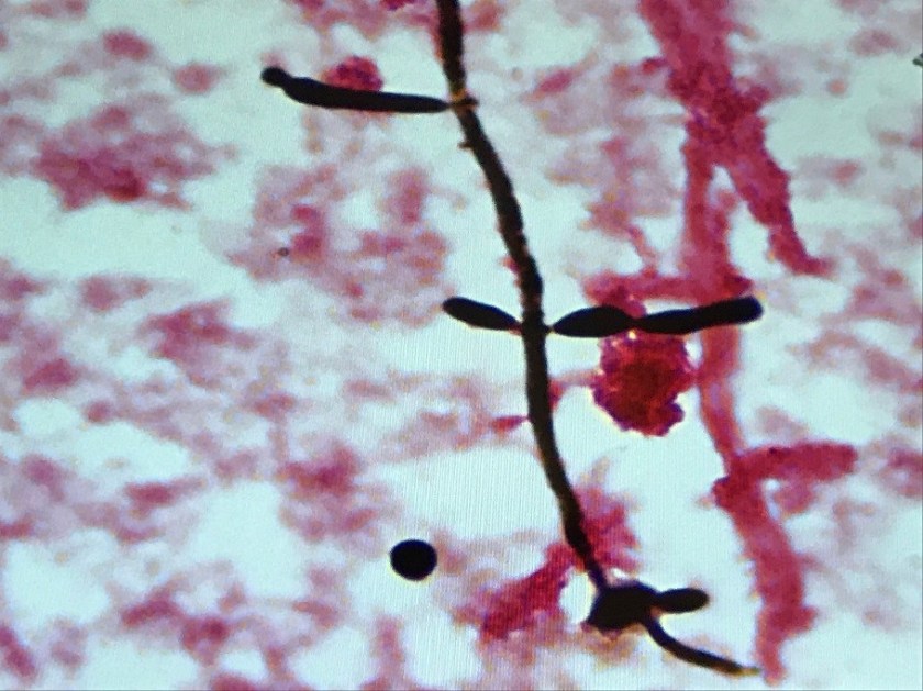 Candida Gram Stain Stock Foto „Candida Spp, Fungi, Emerging