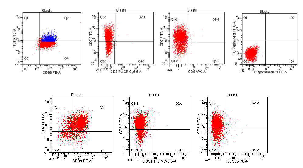 Hematopathology Case Study: A 16 Year Old Male with Fatigue, Fevers ...