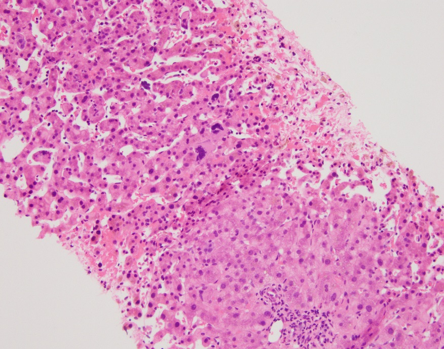 Hematopathology Case Study: Two Cases with Surprising Hematopoetic ...