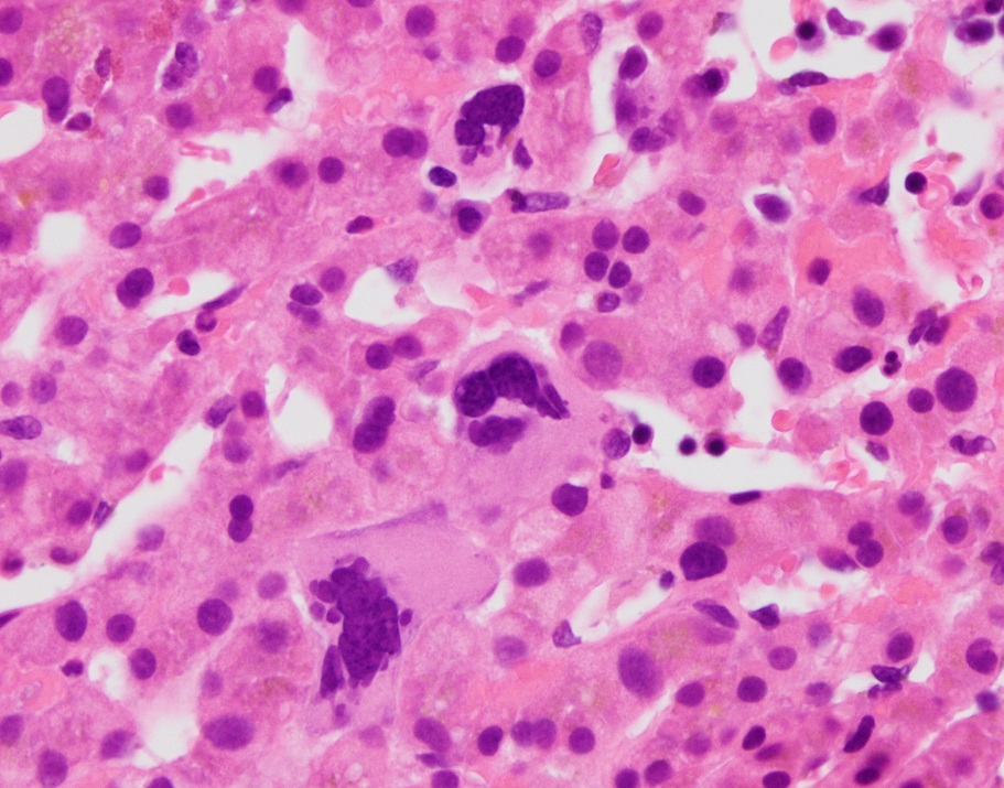 Hematopathology Case Study: Two Cases with Surprising Hematopoetic ...