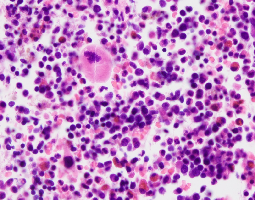 Hematopathology Case Study: Two Cases with Surprising Hematopoetic ...