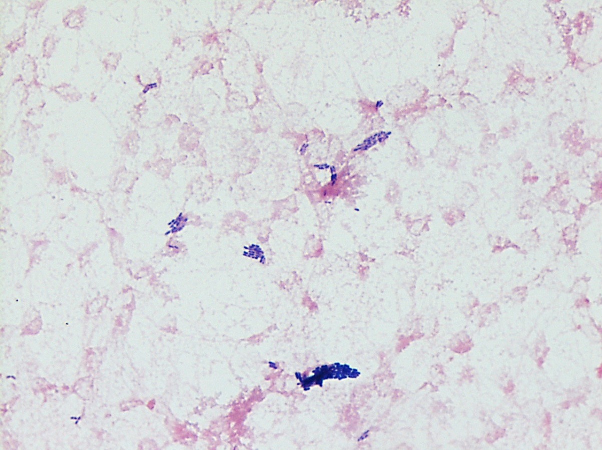 Microbiology Case Study: 64 Year Old Male with Pleuritic Chest Pain and ...