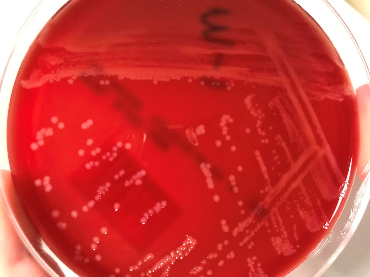 Microbiology Case Study: 64 Year Old Male with Pleuritic Chest Pain and ...
