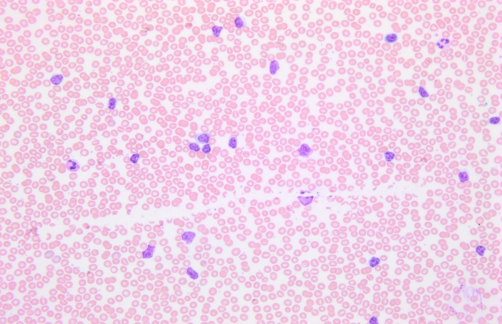 Hematopathology Case Study: The Case of Lymphocytosis – Lablogatory