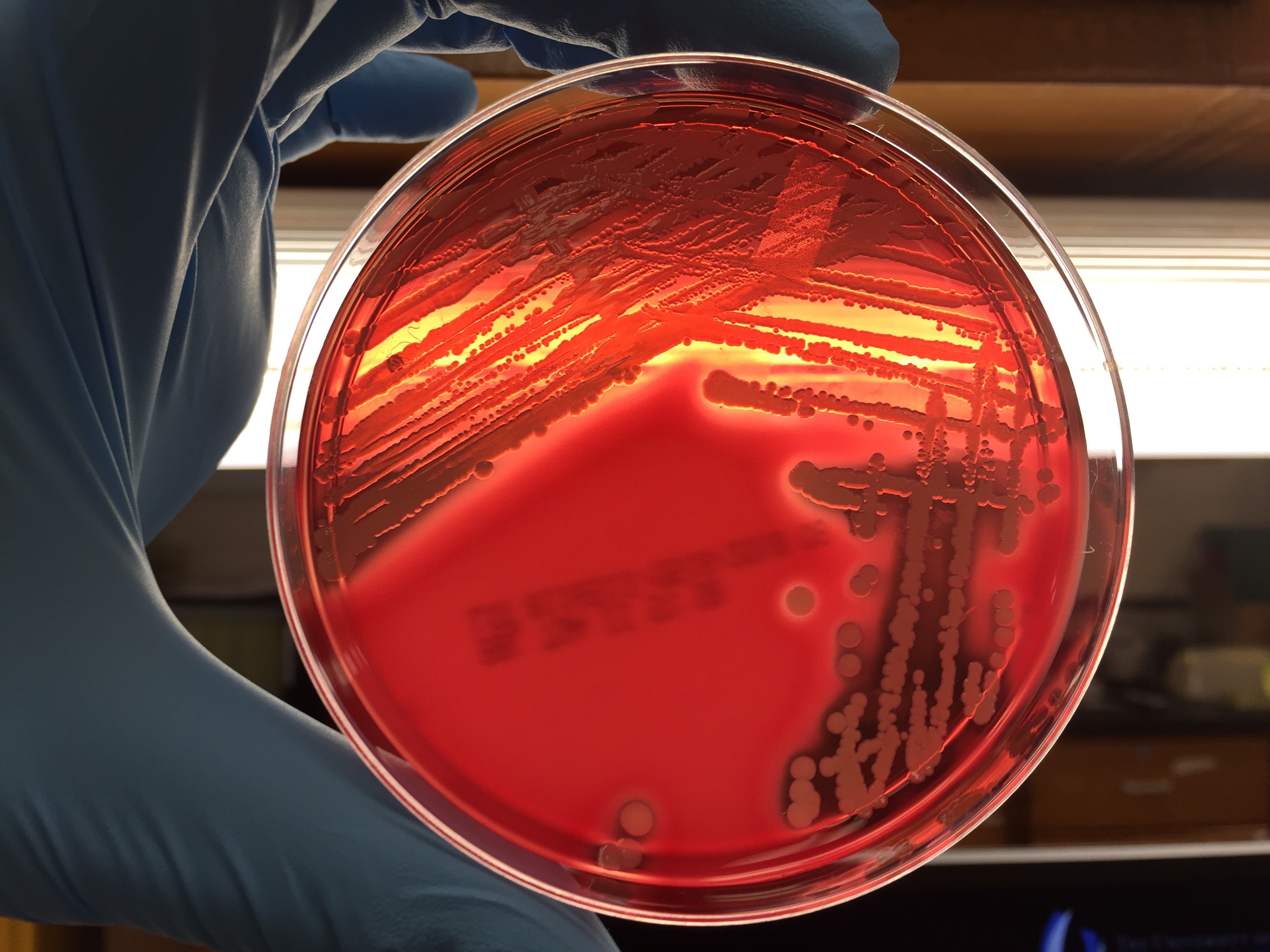Microbiology Case Study: A 37 Year Old Man with Endocarditis – Lablogatory