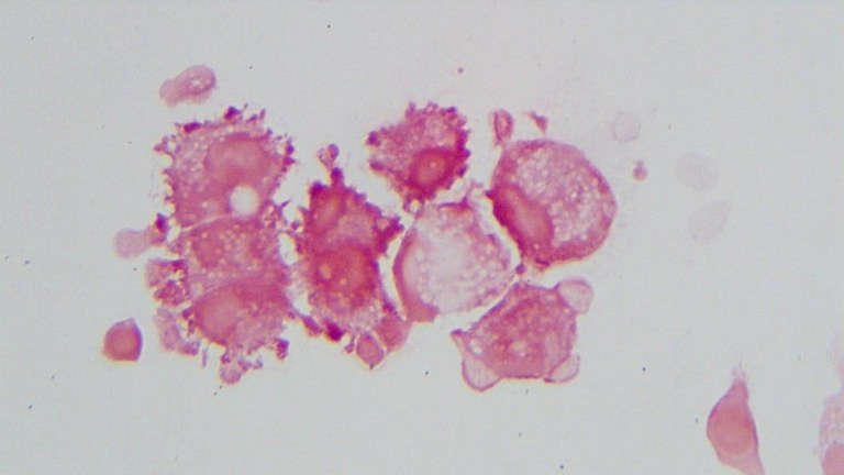 Gram Stain Examination – Beyond Infectious Organisms – Lablogatory