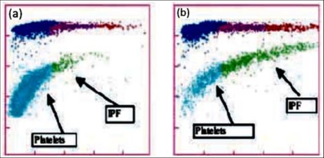 What’s “In” for Thrombocytopenia Diagnosis? Advanced Platelet ...